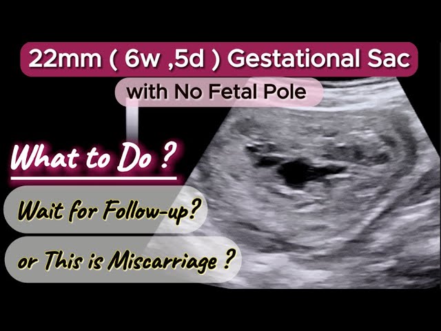 Yolk Sac 6 Weeks Ultrasound Emdocs Net Emergency Medicine