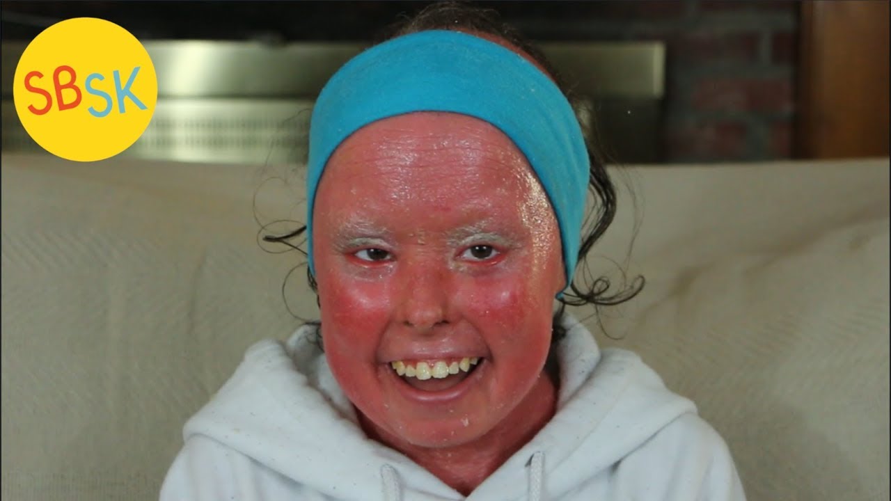 Harlequin Ichthyosis Survivor Expecting The Most Unexpected A