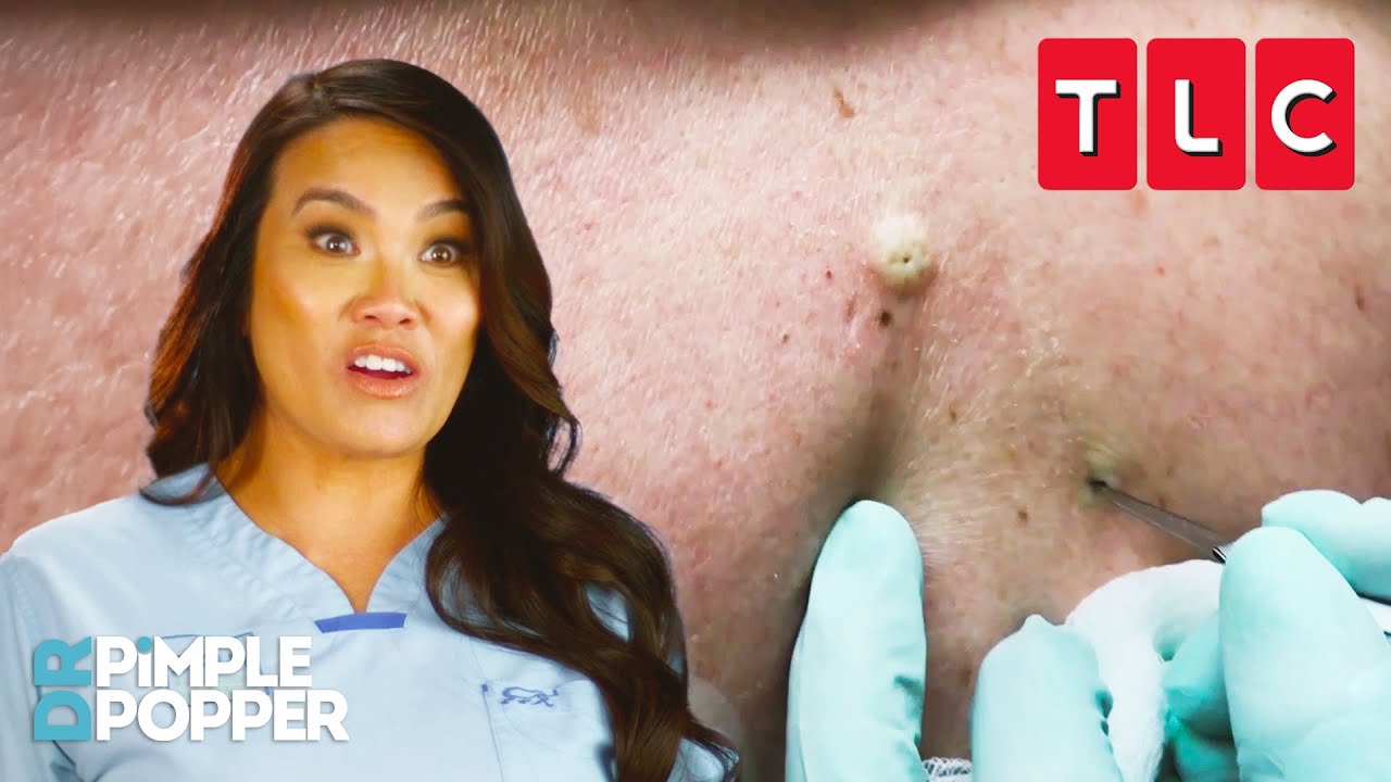 The Best Pimple Popper Dr Pimple Popper The Best Pimple Popping