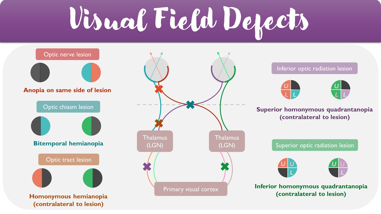 Visual Field Defects And Pathways