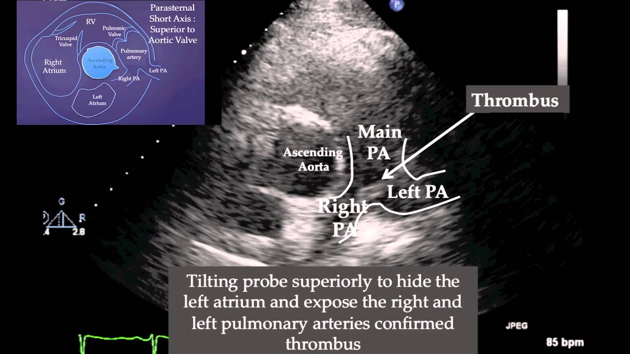 Pulmonary Embolism On Echocardiogram Youtube