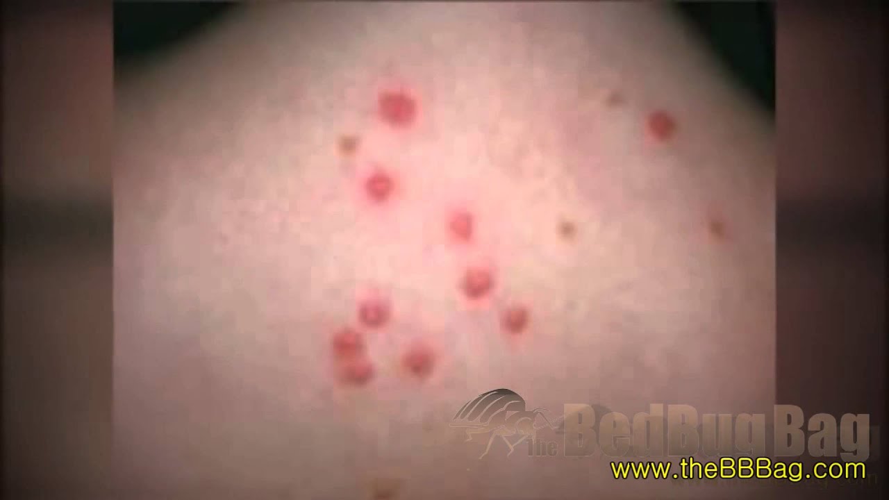 Bed Bug Bite Rash