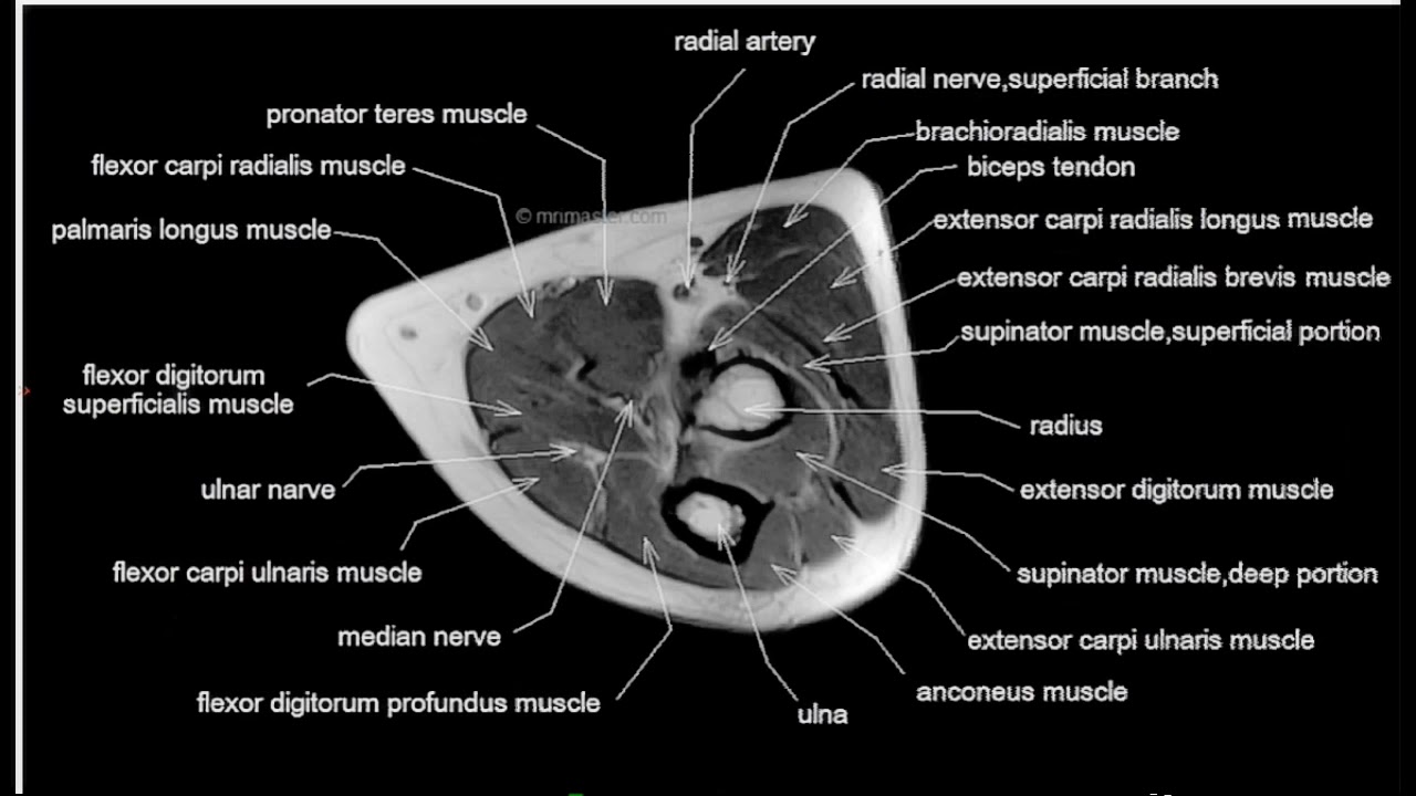 Mri Anatomy Elbow Muscles At David Dodd Blog
