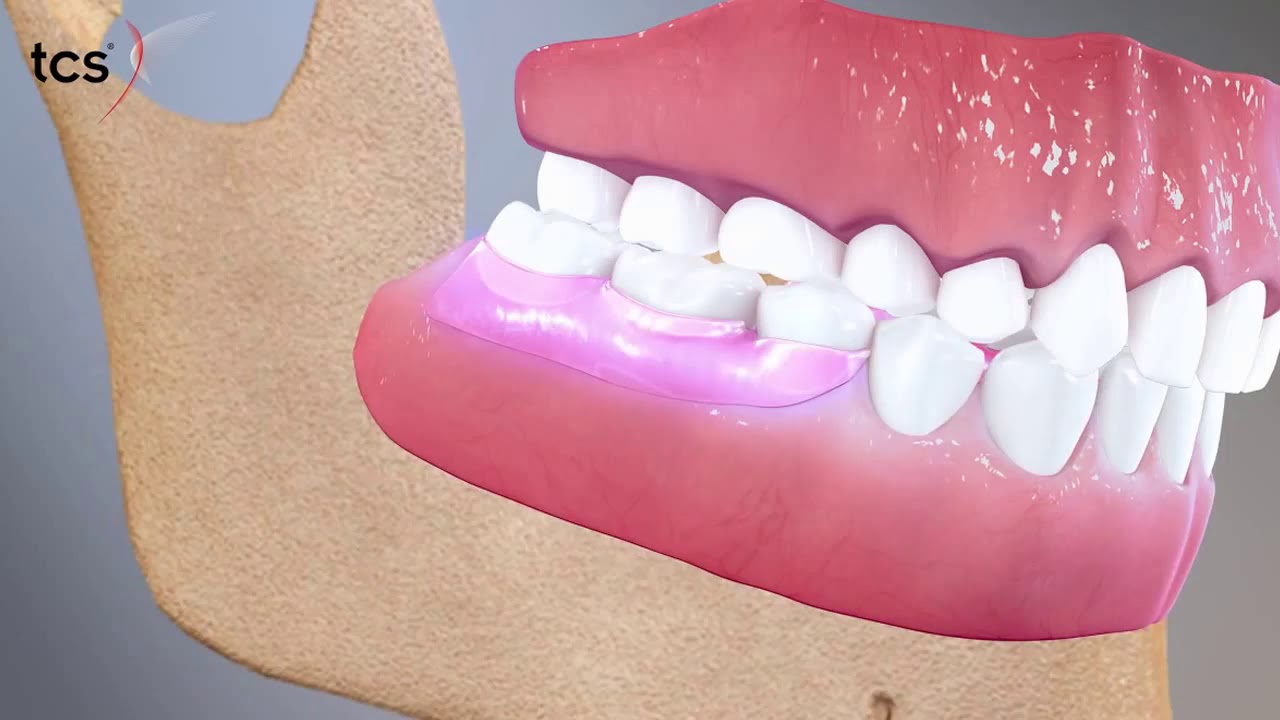 Flexible Partial Dentures Animation Youtube