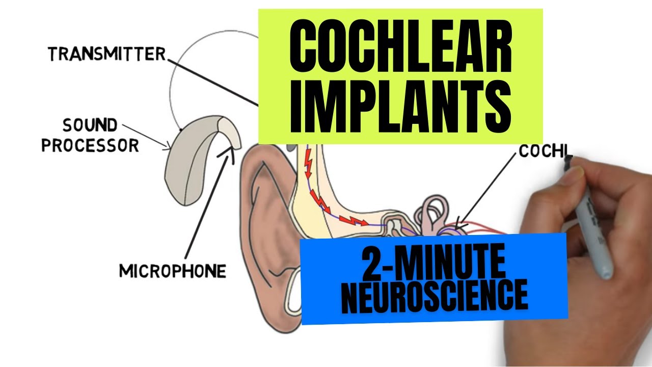 2 Minute Neuroscience Cochlear Implants Youtube