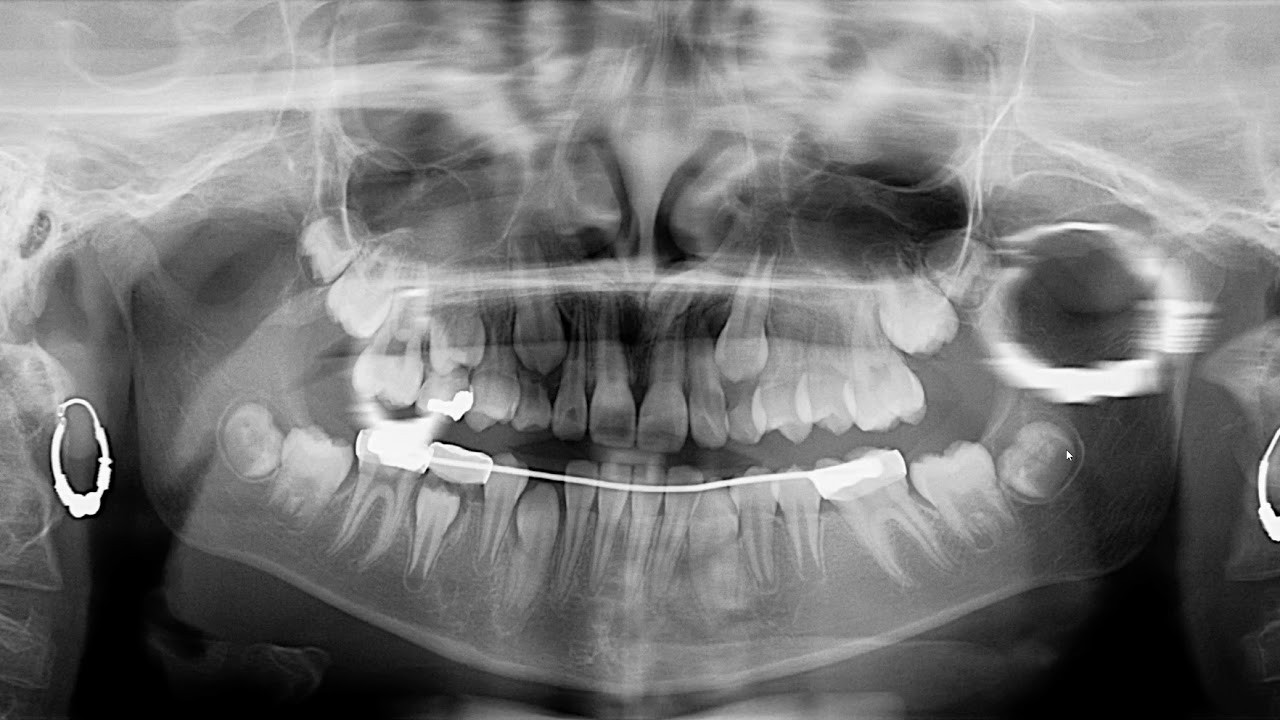 Understanding The Ghost Images On Panoramic Radiograph Youtube