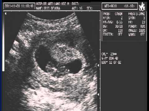 Ultrasonido De Mi Bebé Alos 2 Meses Te Amo Youtube