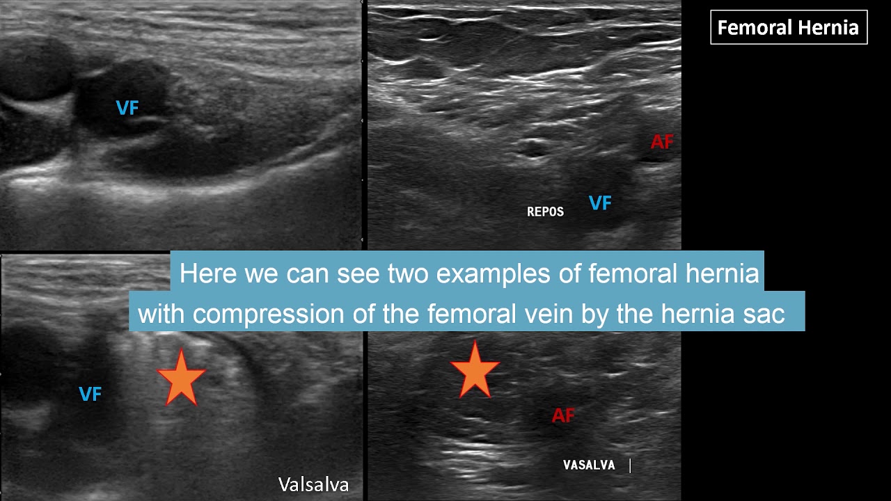 Groin Pain And Ultrasound Part 2 Inguinal Femoral Sport Hernia