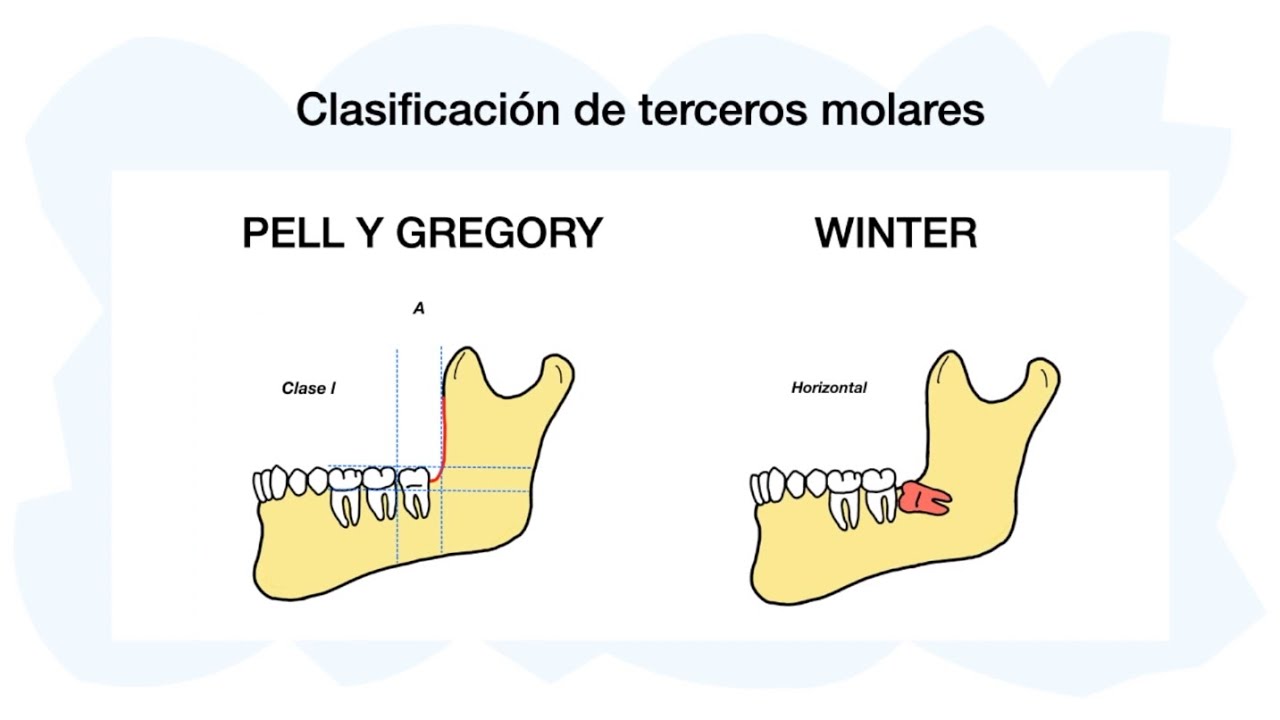 Pell Y Gregory Winter Clasificaciгіn Terceros Molares рџ Youtube