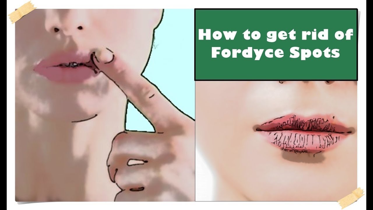 Fordyce Spots On Lips Treatment How To Get Rid Of Them Youtube