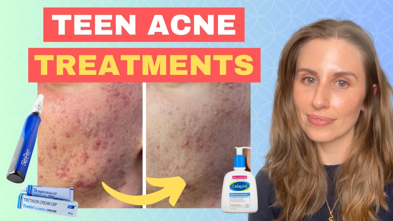 The Best Treatments For Teen Acne That Will Clear Your Skin Youtube