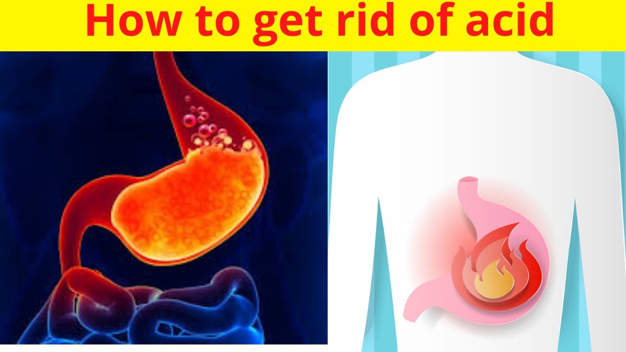 Dry Acid Reflux Throat At Gabriel Higgins Blog