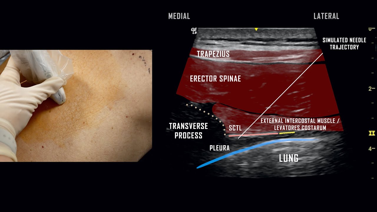 Paravertebral Block