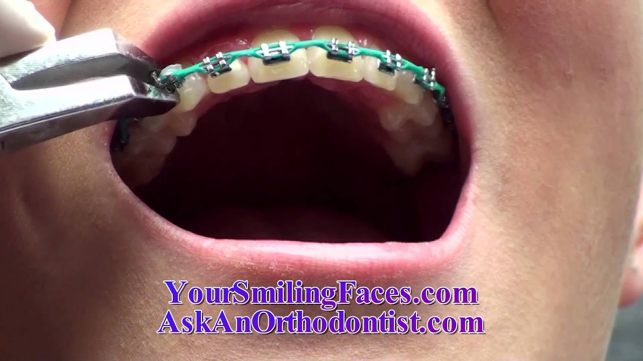 Take Out Braces Online