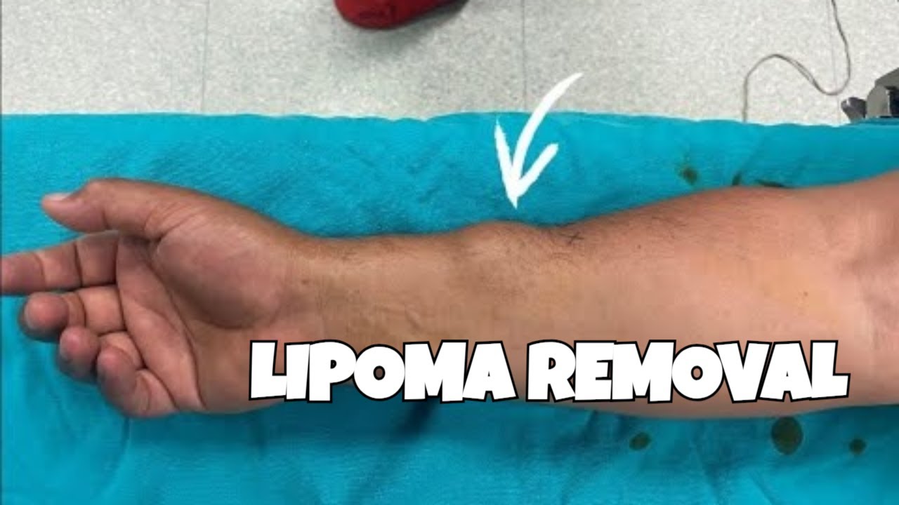 I Got My Forearm Lipoma Removed Youtube