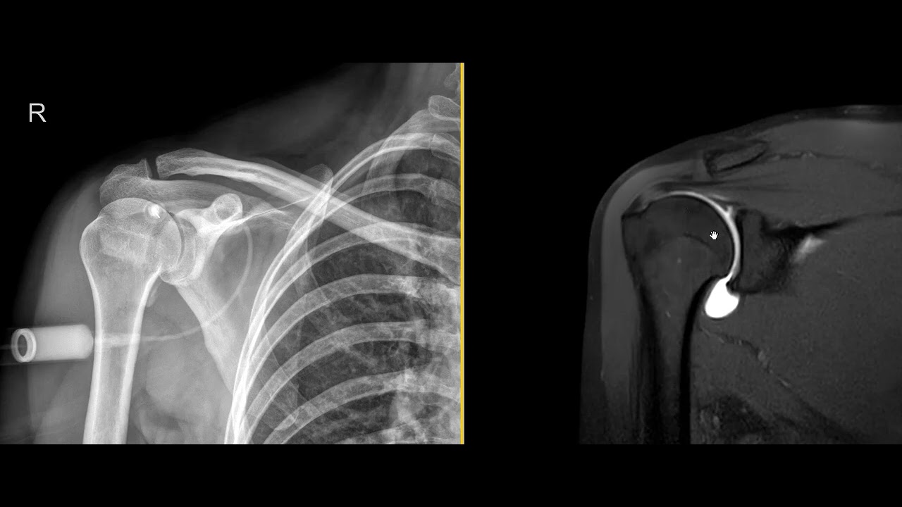 What Is An Mri Shoulder Arthrogram Youtube