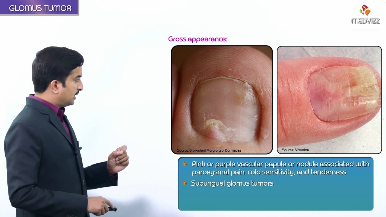 Glomus Tumor How To Discuss