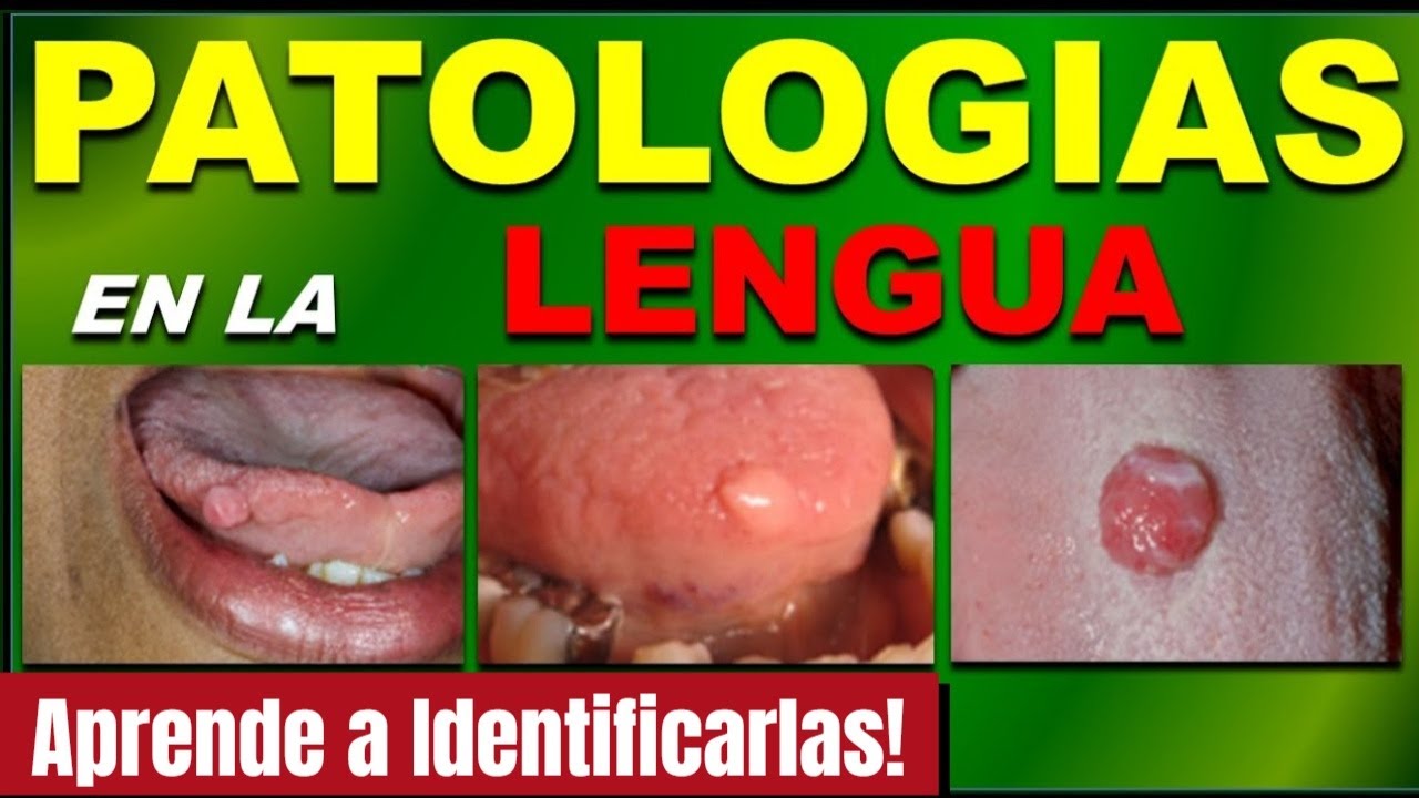 Lesiones Linguales Comunes Conoce Estas Patologías Benignas Youtube