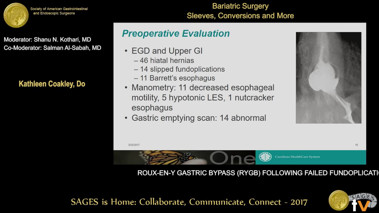 Rygb Following Failed Fundoplication Youtube