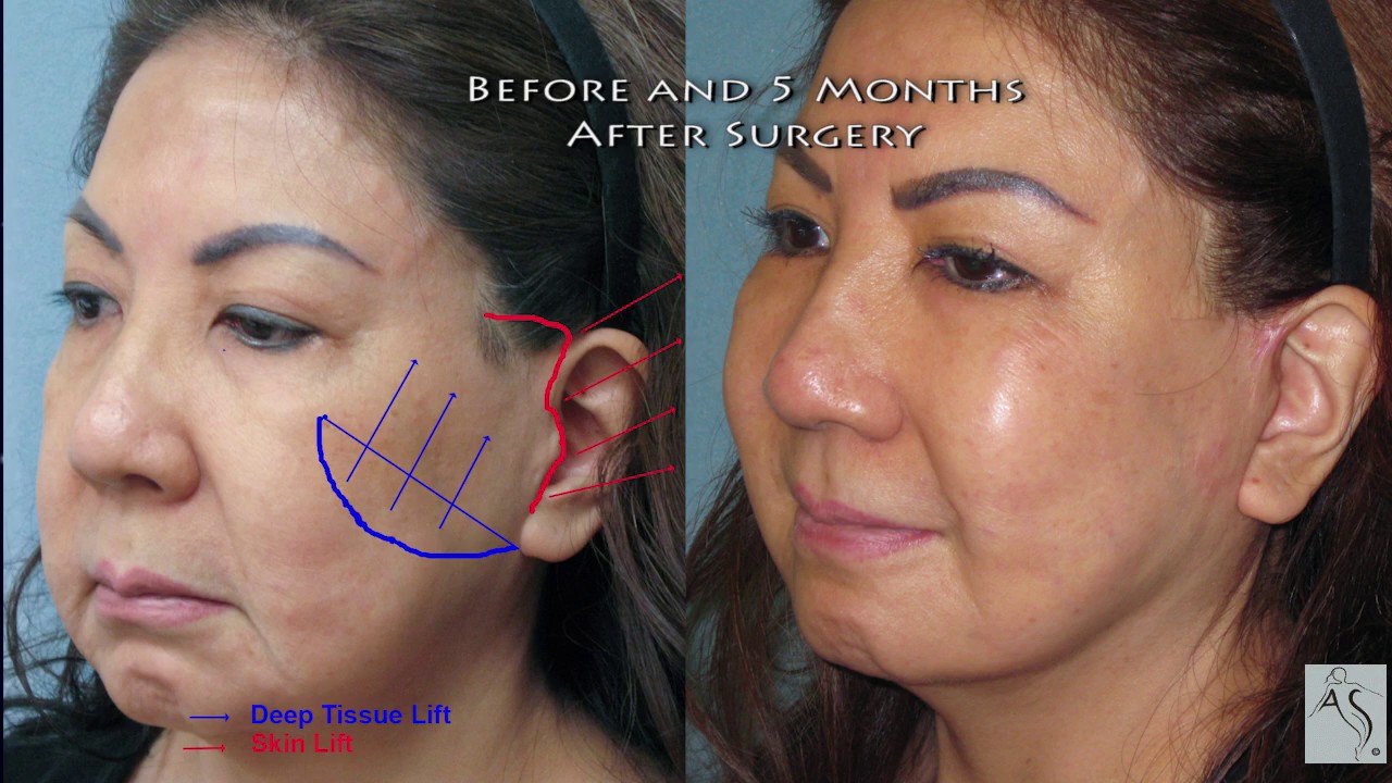 Facelift Youtube