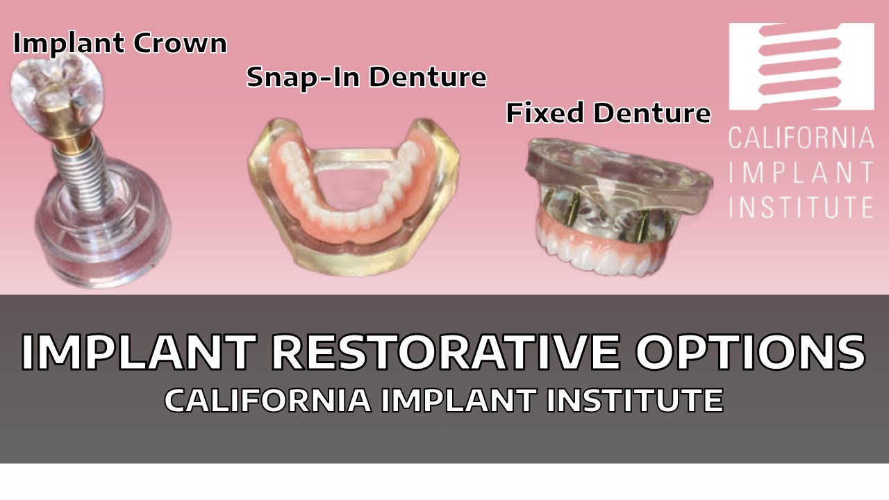 Restorative Options Once You Have Dental Implants 2024 Youtube