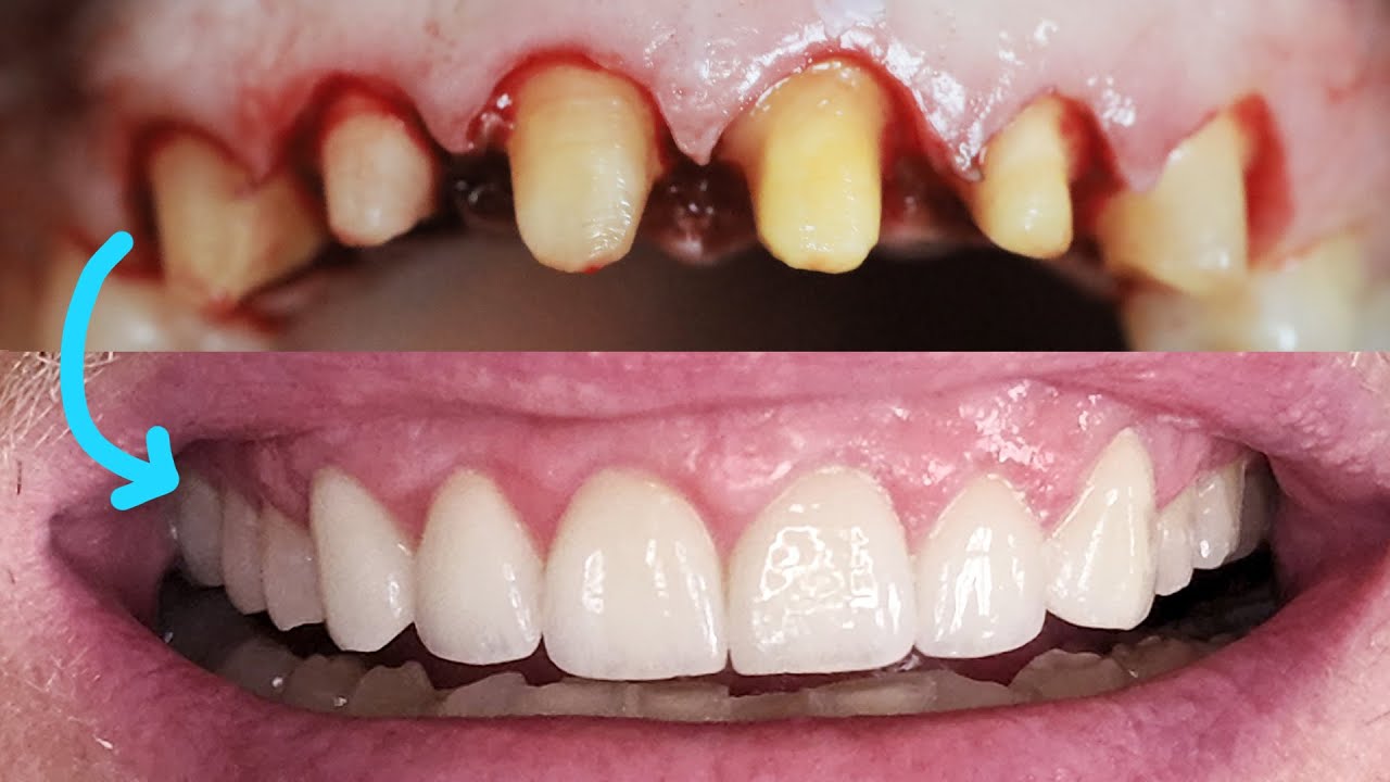 Front Tooth Crowns Before After Cosmetic Dentist Smile Makeover Emax