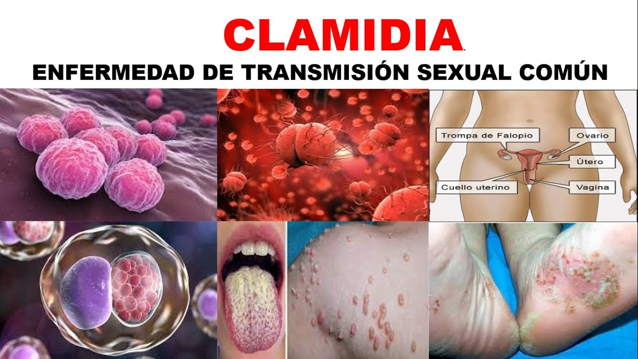 Clamidia Enfermedad De Transmision Sexual Youtube