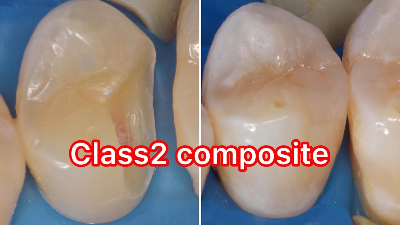 Class Ii Composite Resin Restoration Youtube
