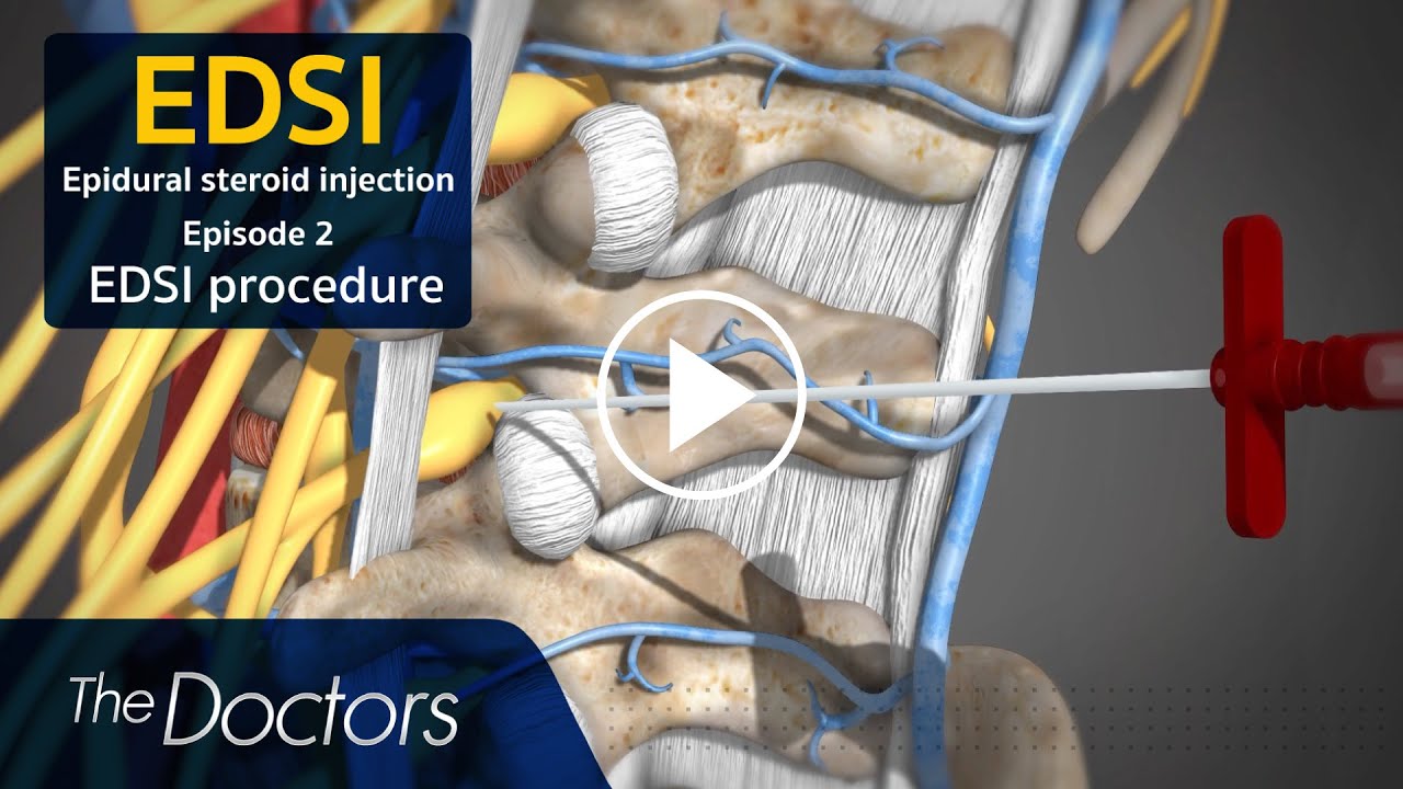 The Doctors Epidural Steroid Injection Edsi Procedure Youtube
