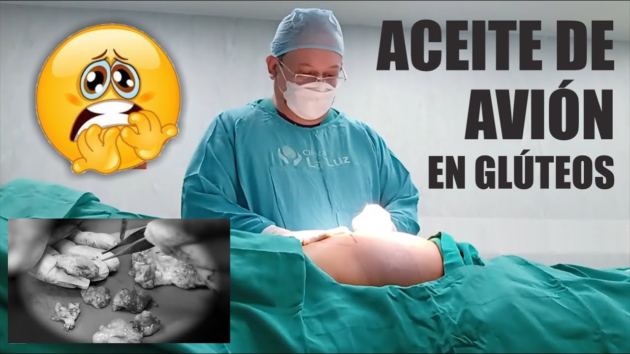 Aceite De Avión En Los Glúteos Cirugía De Retiro De Biopolimeros