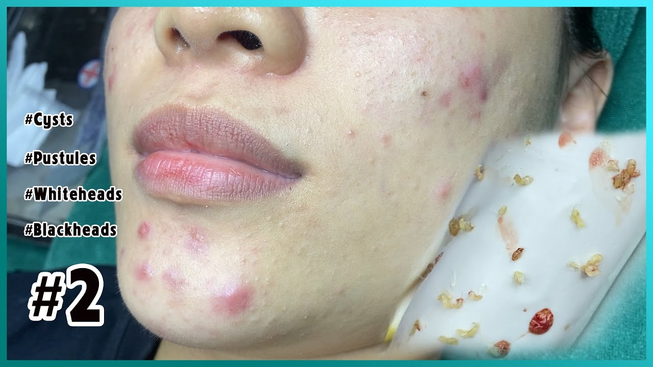 Pimple Tv The Best Pimple Popping 2023 Videos You Ll Find On The Internet