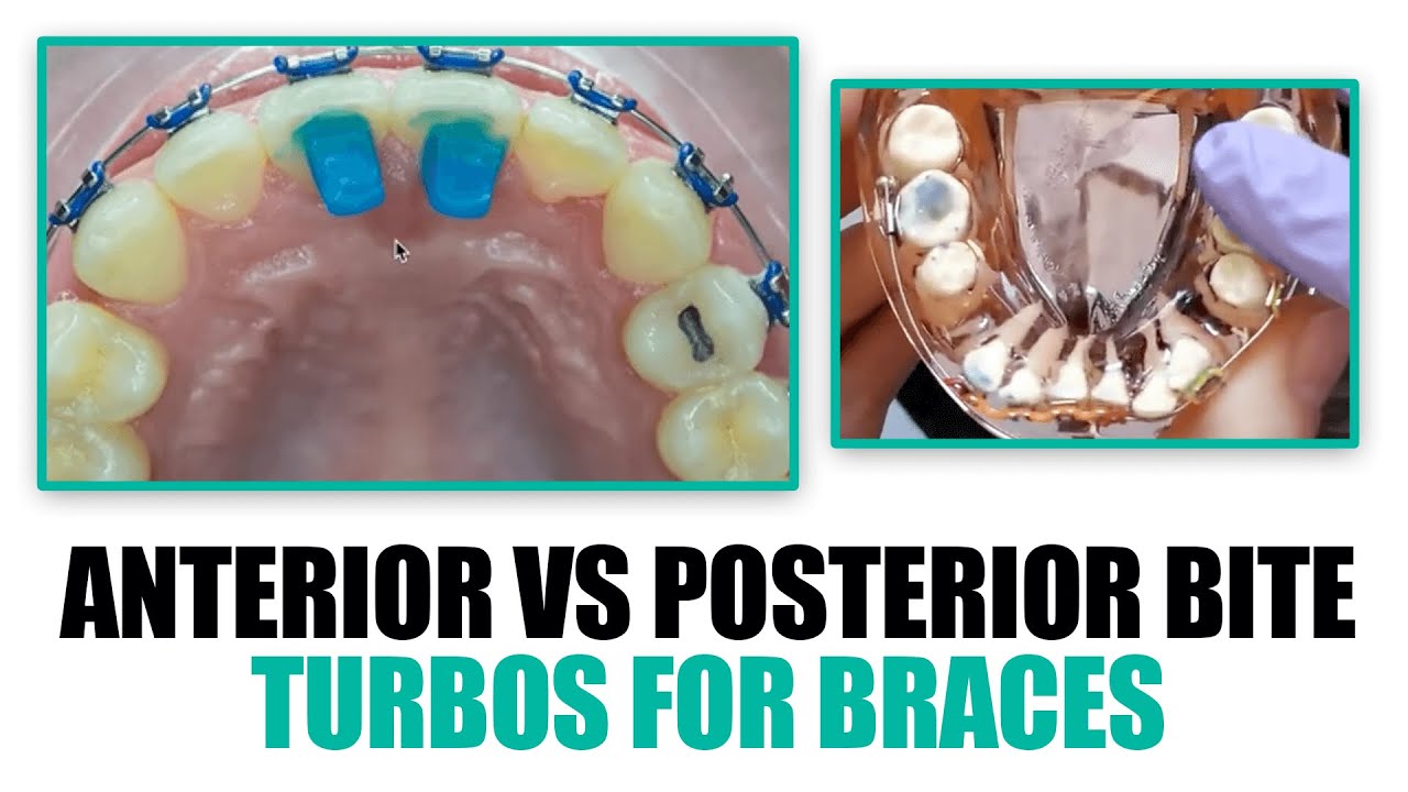 Posterior Turbos Braces At Amy Yates Blog
