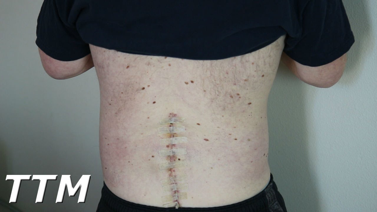 My Double Spinal Fusion Surgery After 2 Weeks Youtube