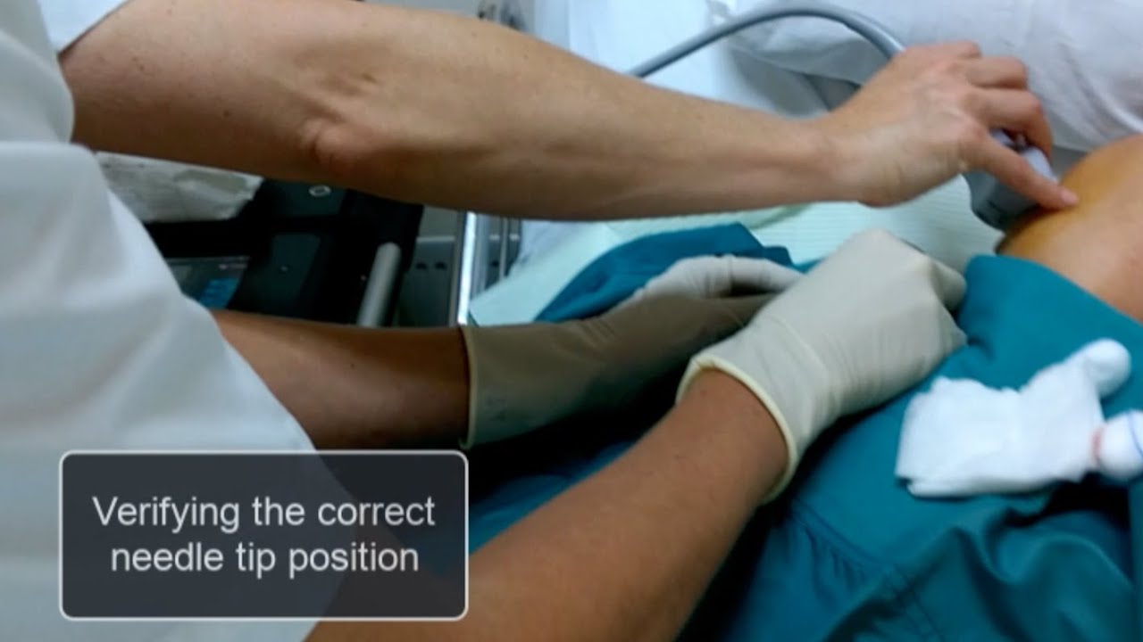 How To Find Needle On Ultrasound At Gayle Poston Blog