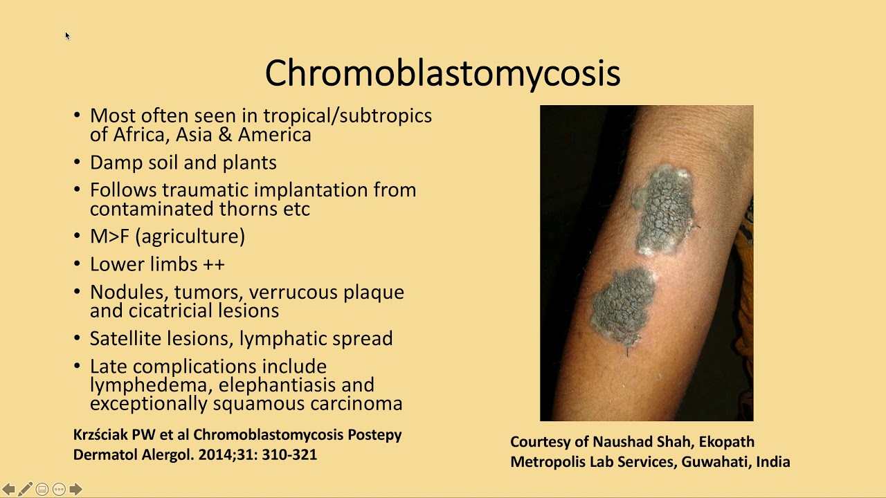 Chromoblastomycosis Phillip H Mckee Youtube