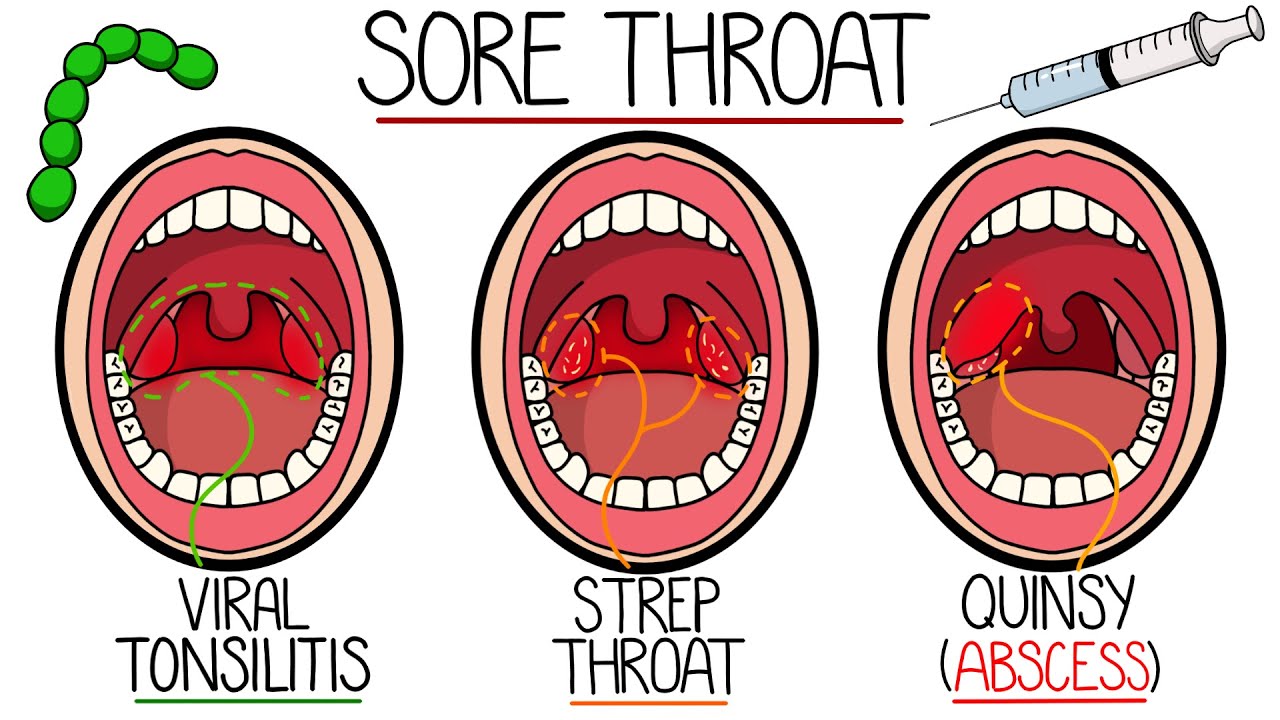 No Tonsils Strep Throat