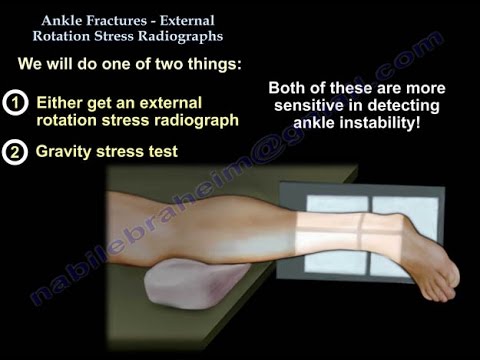 How To Perform Stress Views Of Ankle
