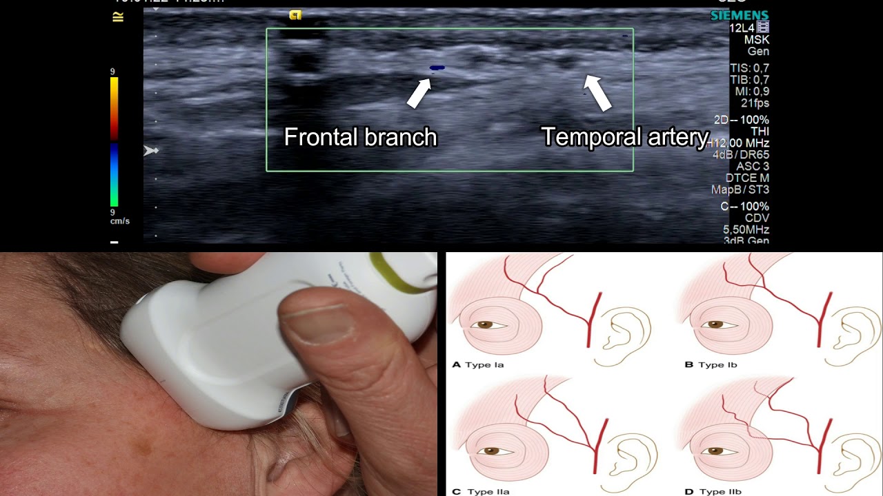 Temporal Artery Ultrasound Cranial Arteritis Temporal Arteritis