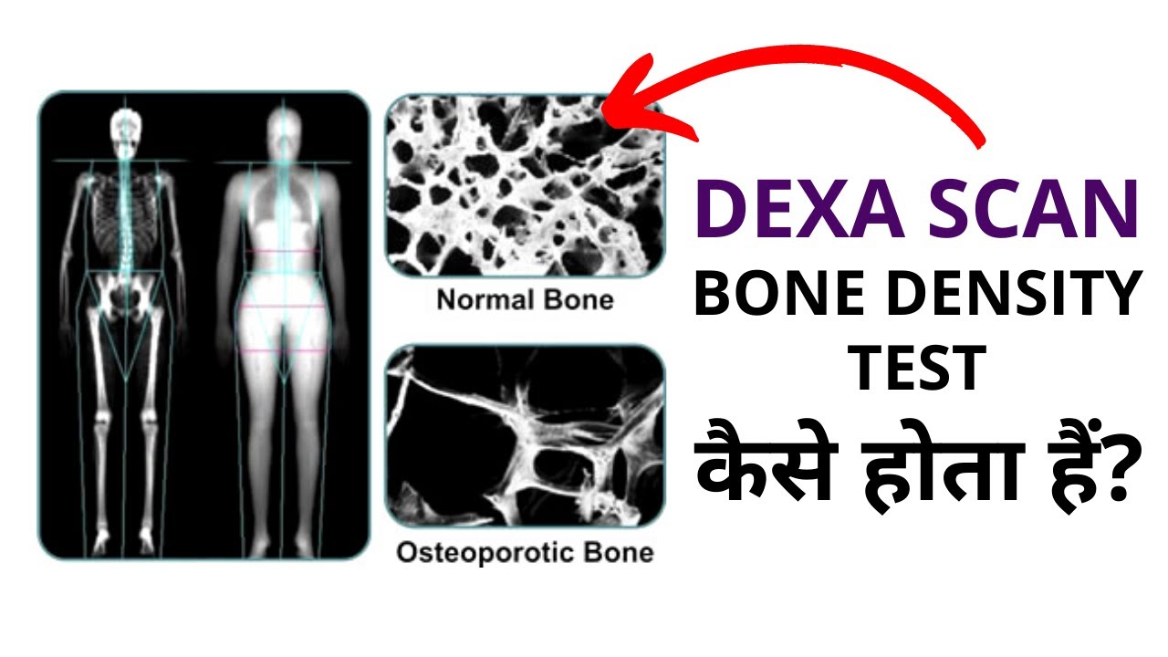 Dexa Scan Bone Density Test