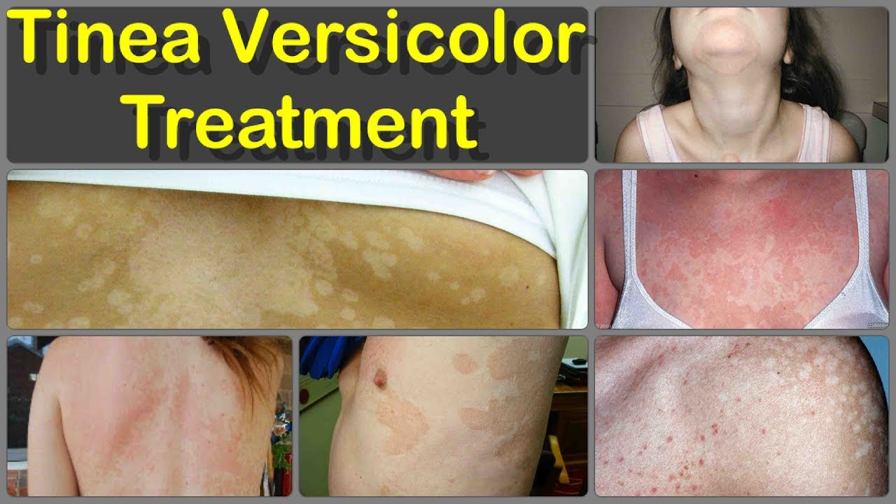 Tinea Versicolor Causes Symptoms Treatment Tinea Versicolor