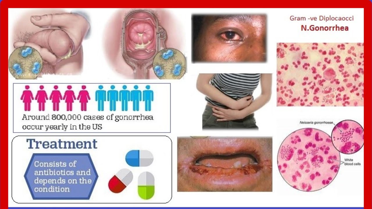 Gonorrhea Symptoms Causes Treatment And Diagnosis Sexually Transmitted