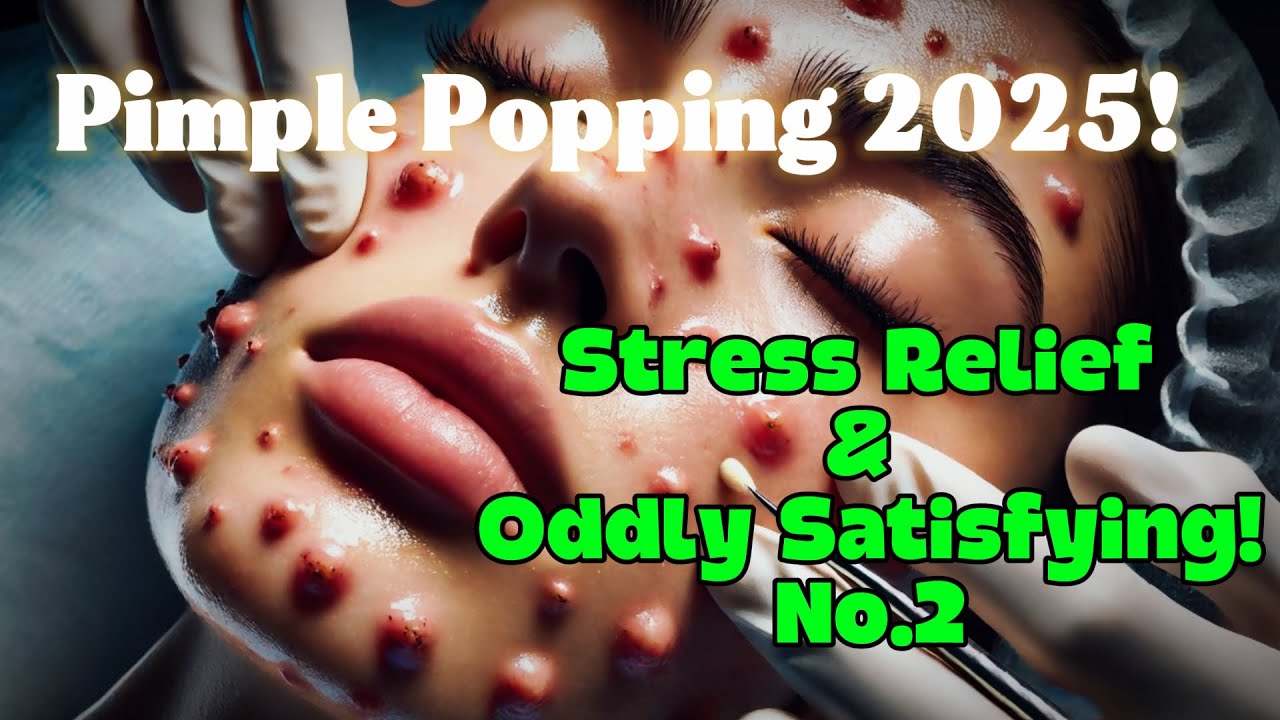 Pimple Popping 2025 Stress Relief Oddly Satisfying 2 Pimple