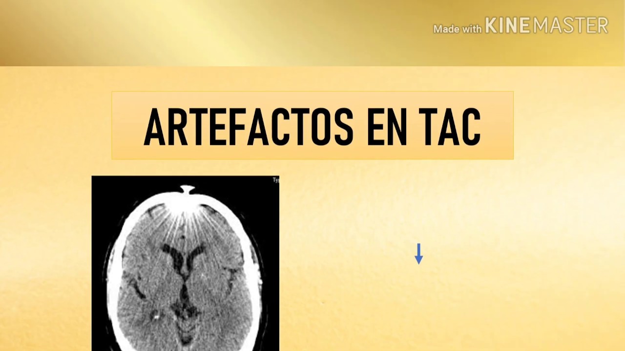 Artefactos En Tomografía Parte I Youtube