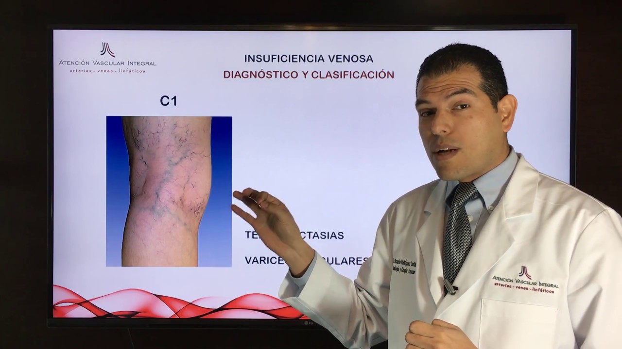 5 Insuficiencia Venosa Diagnóstico Y Clasificación Youtube