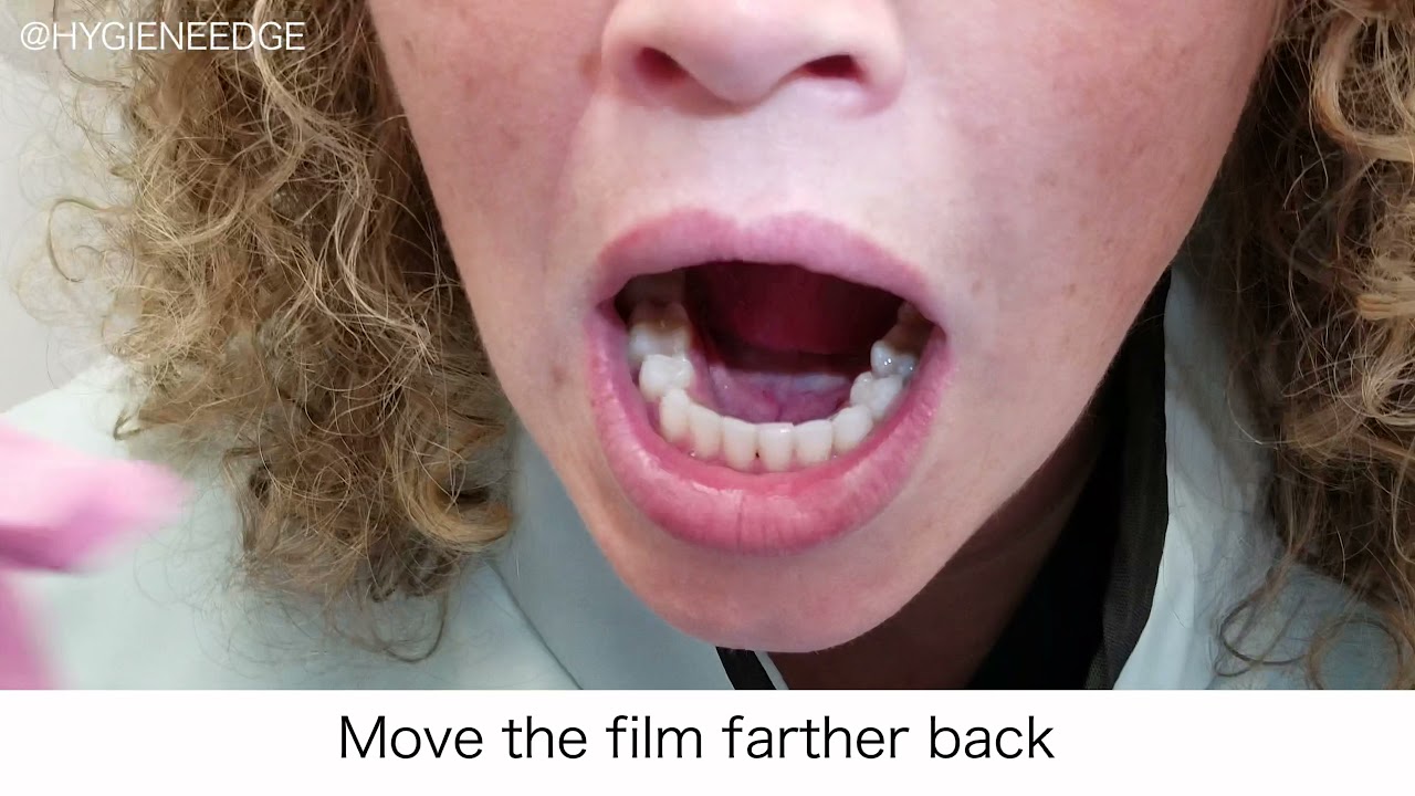 Tricky Tori Tips For Anterior Pa S Youtube