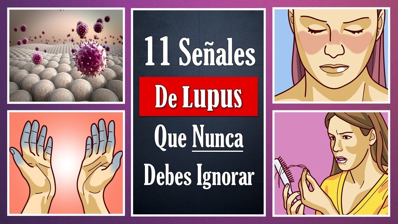 Qué Es El Lupus Conoce Los Síntomas Y El Tratamiento Hysk