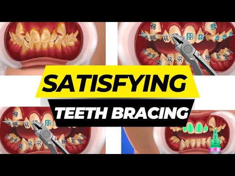 Asmr Teeth Care Animation Asmr Teeth Tapping Asmr Teeth Braces