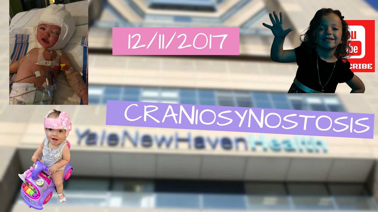 Ava Has Surgery For Craniosynostosis At Yale New Haven Hospital Youtube