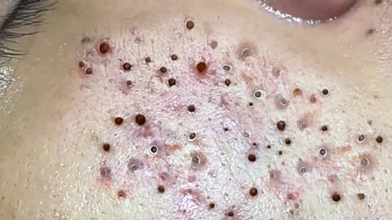 Completely Remove Blackheads For Patients At Sac Dep Spa Youtube