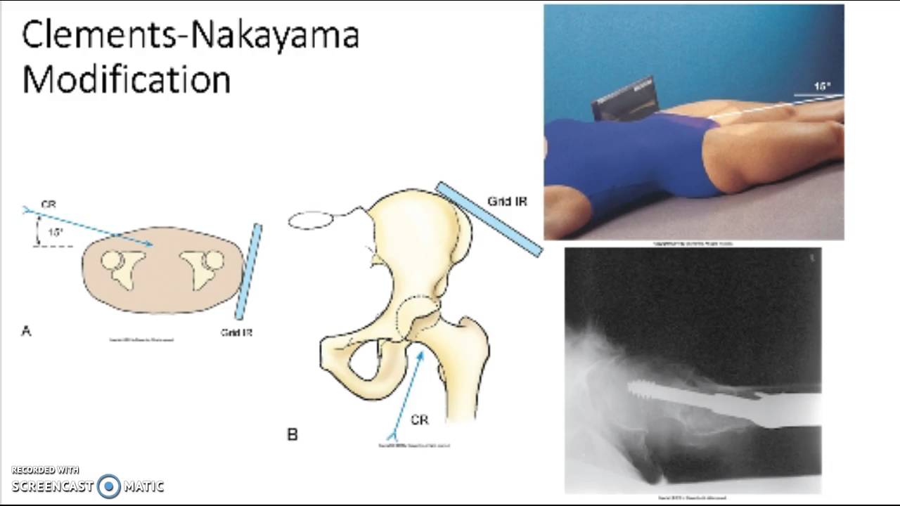Hip Pelvis Trauma Youtube